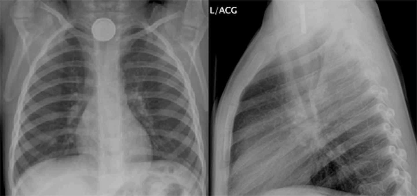 Kids ENT Health Month: Awareness of the dangers of button battery ...