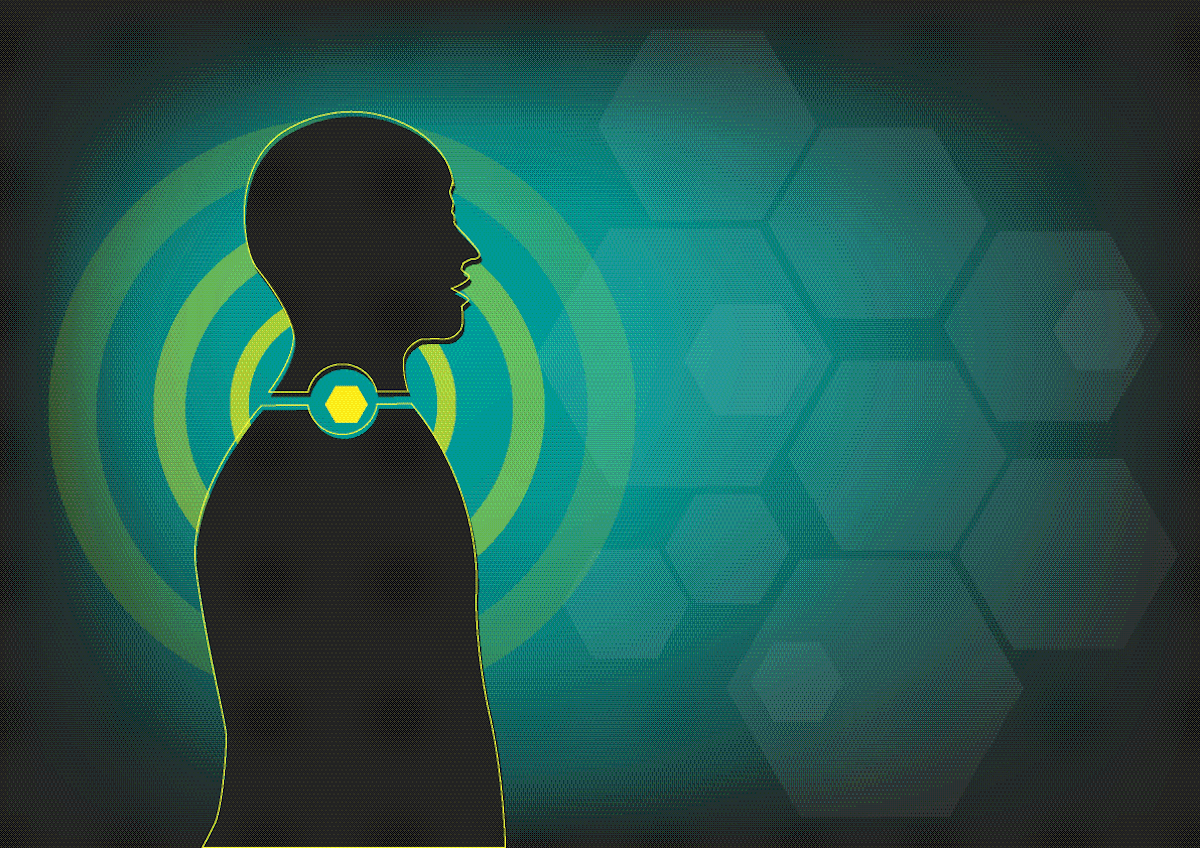 Glottic Cancer Transoral CO2 Laser Microsurgery (TOLMS): Current ...