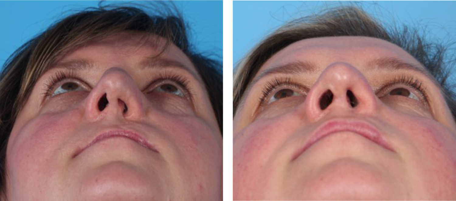 Completing the Care Cycle in the Adult Patient with Cleft Lip–Palate ...