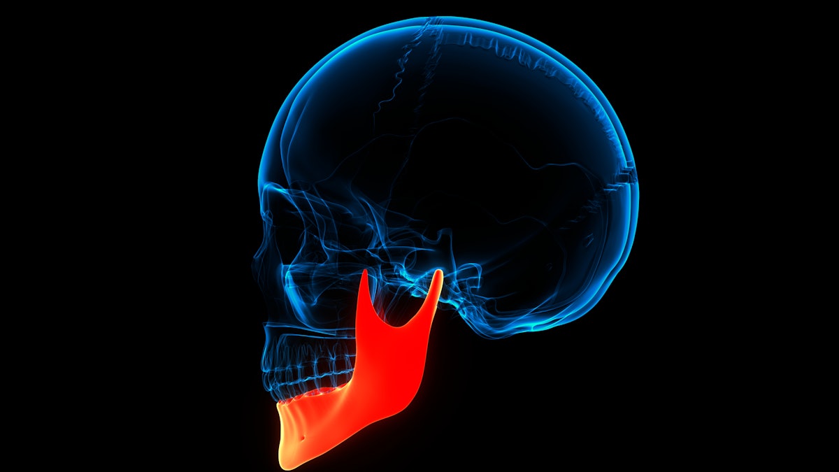 Treatment of Subcondylar Fractures of the Mandible: A Shifting Paradigm ...