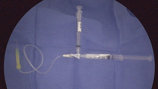 Sclerotherapy for the Management of Epistaxis in HHT Telangiectasia ...