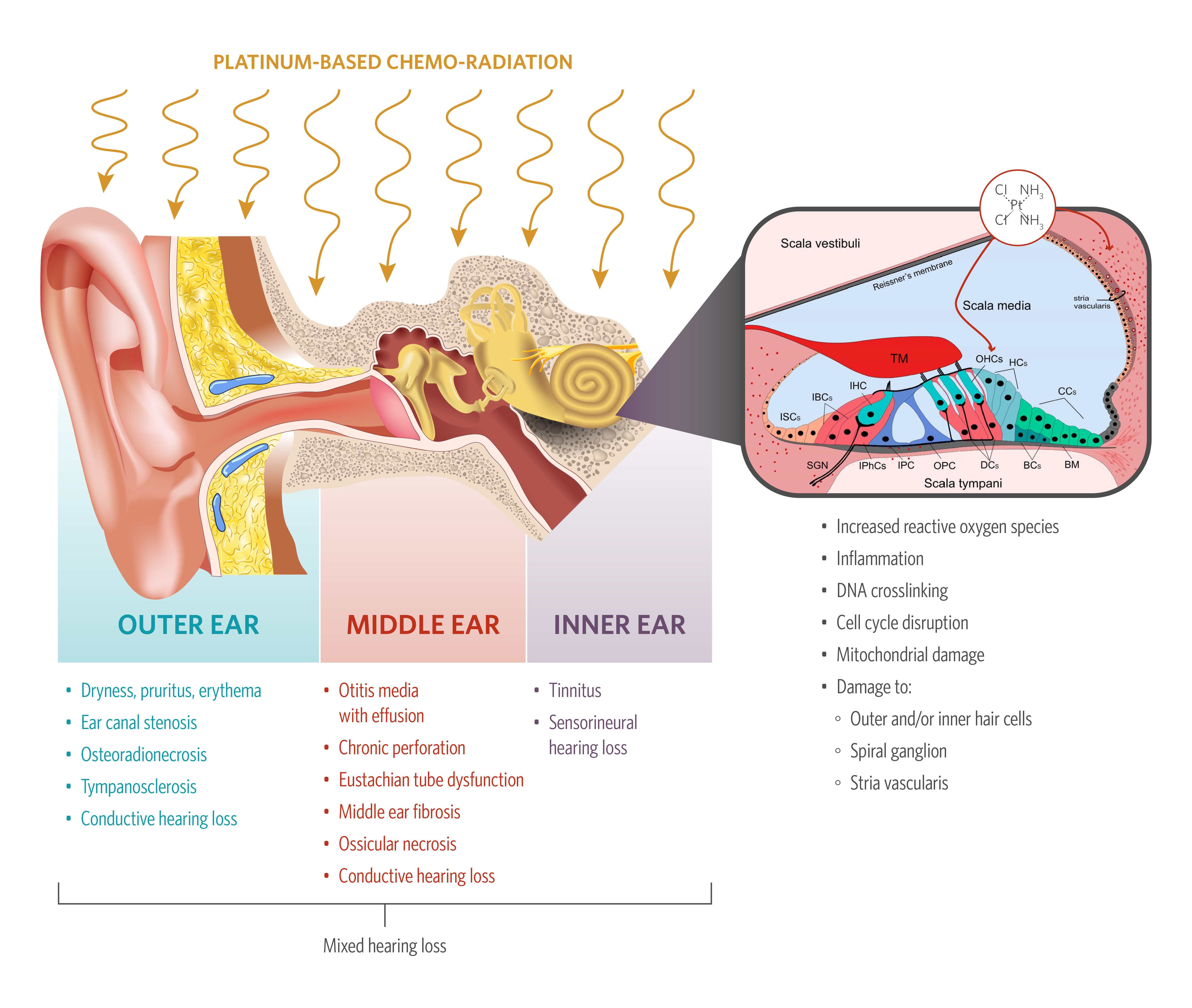 Hearing Loss in Cancer Patients | AAO-HNS Bulletin