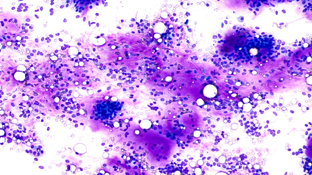 The Milan System for Salivary Gland Cytopathology | AAO-HNS Bulletin