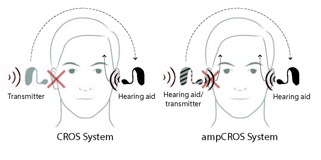 Pearls from Your Peers: Adult Unilateral Hearing Loss and Single-Sided ...