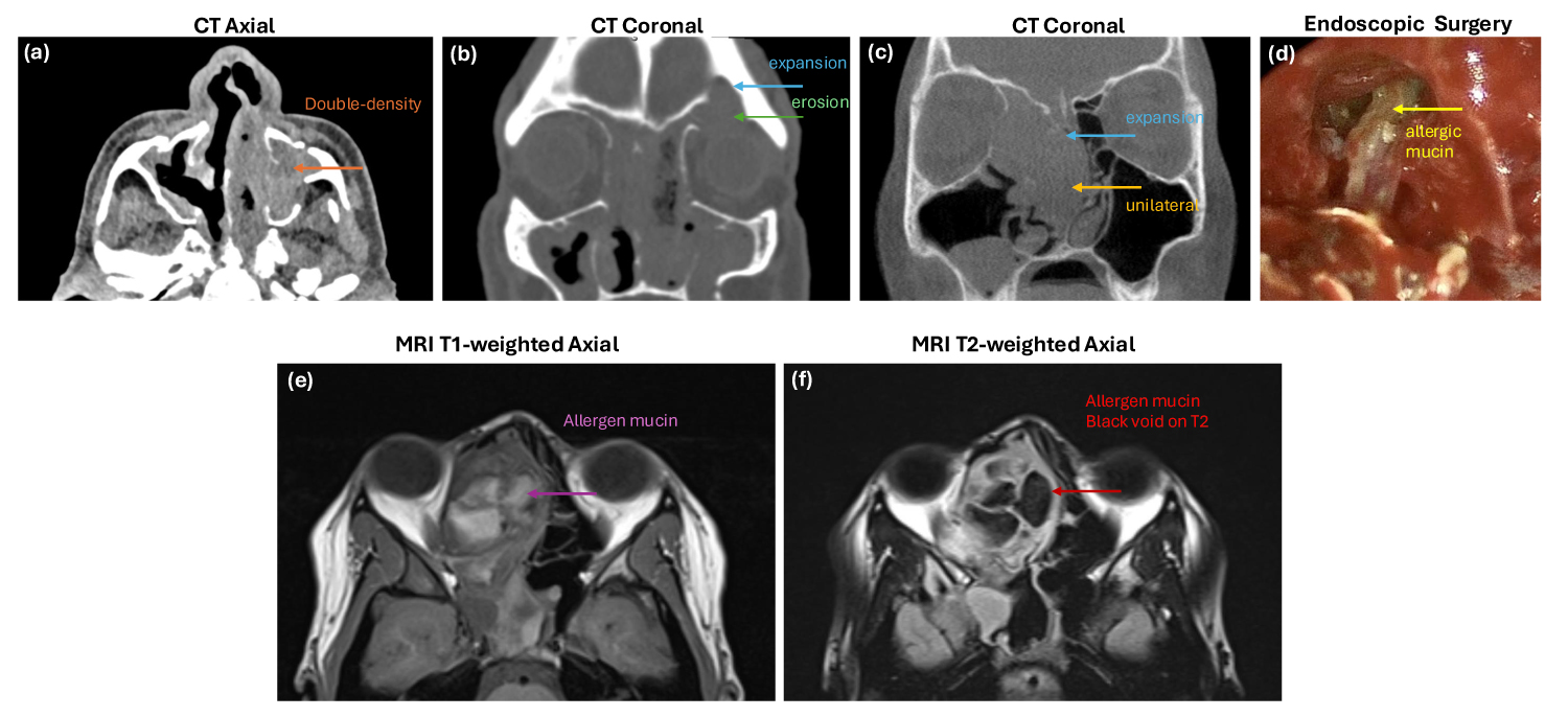 Allergic Fungal Rhinosinusitis Management: From Clinic to Operating ...